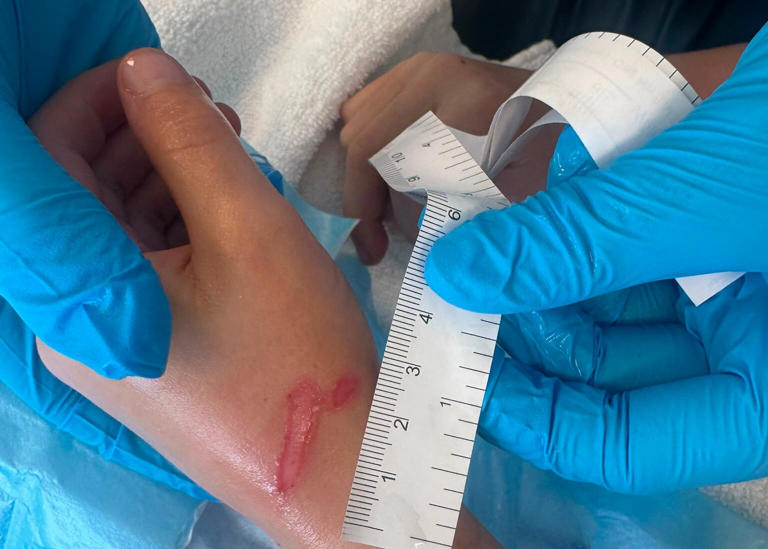 Children burned by exploding 'squishy' toys amid trend to heat them in ...
