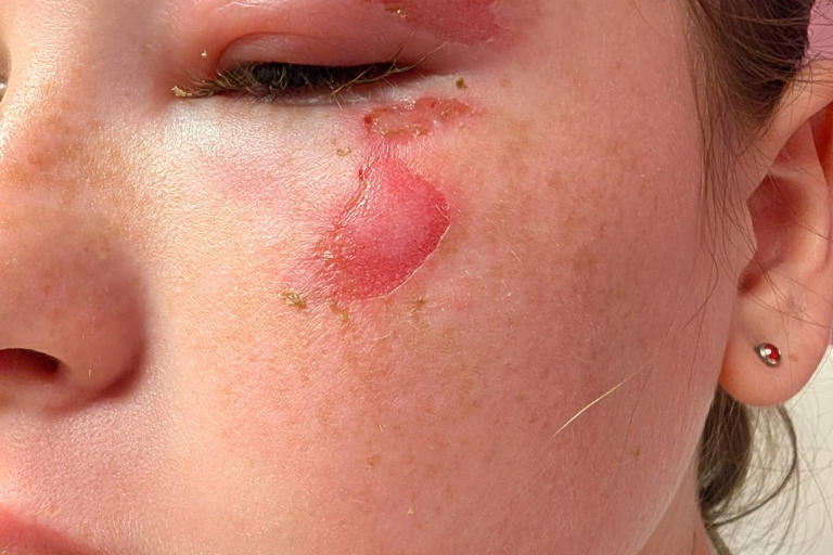 Warning over online ‘squishy’ trend leaving children with skin grafts