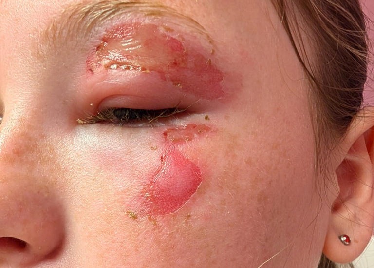 Children burned by exploding 'squishy' toys amid trend to heat them in ...