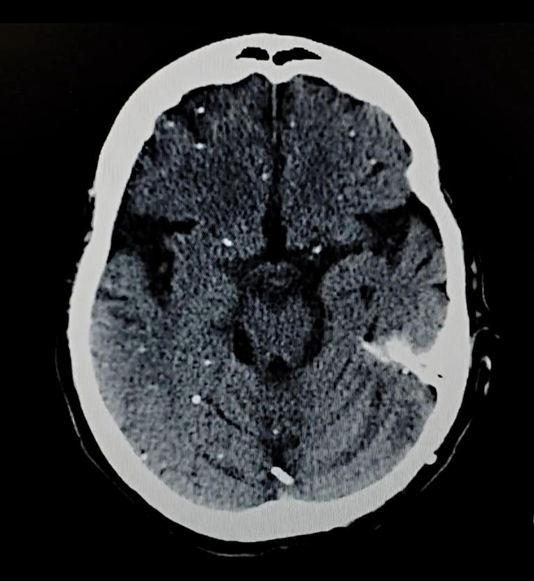Doctors thought man had deadly brain cancer — the reality was much grosser