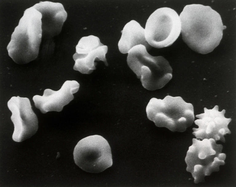 What the latest progress on sickle cell means for Black Americans