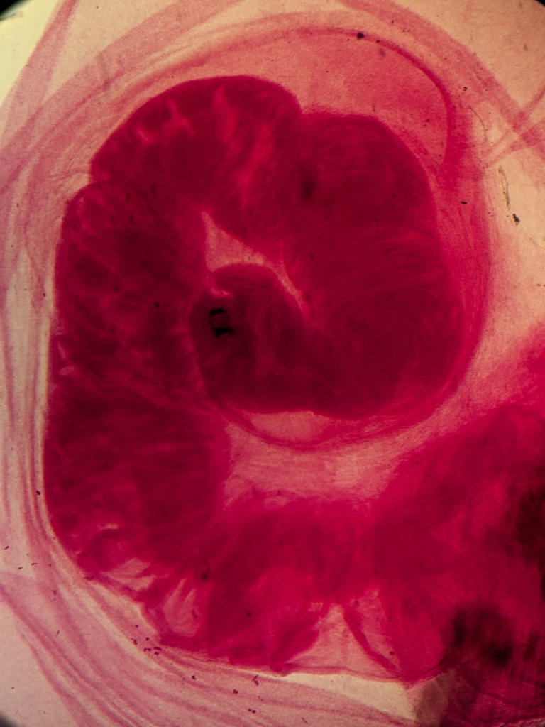 Doctors thought man had deadly brain cancer — the reality was much grosser