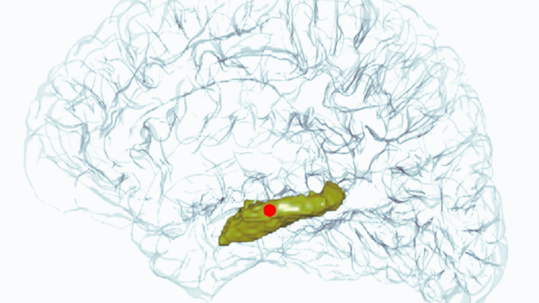 Startling brain activity under anesthesia challenges our understanding ...