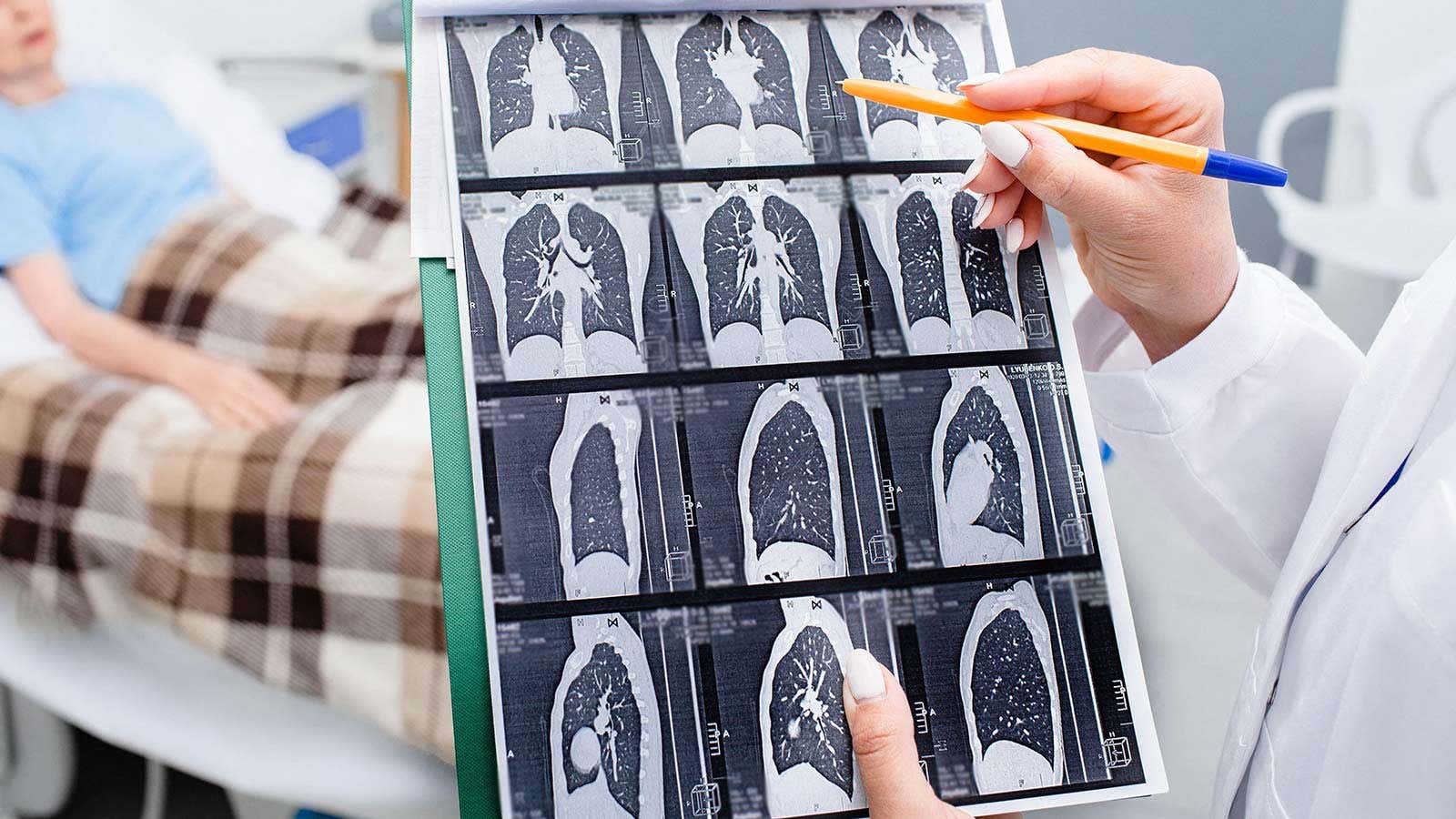Study homes in on simpler lung cancer screening criteria