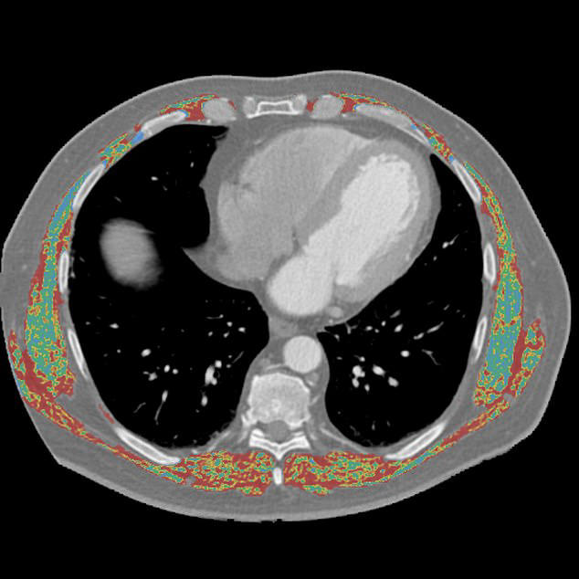 People with healthier chest and back muscles may have lower heart ...