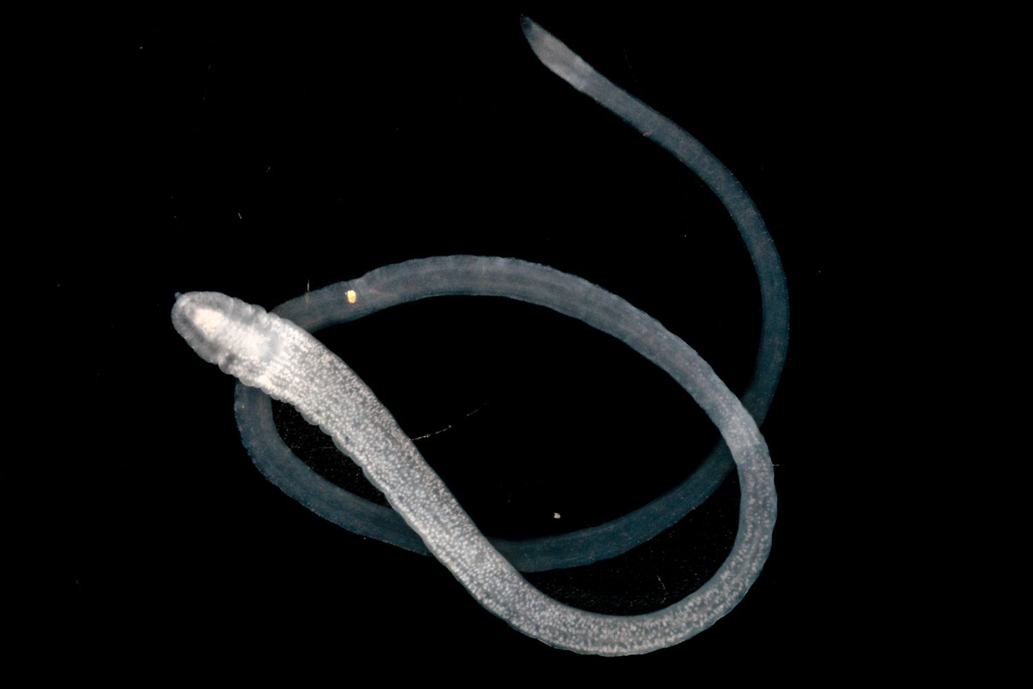 Doctors thought he had cancer. Then they found a tapeworm in his brain
