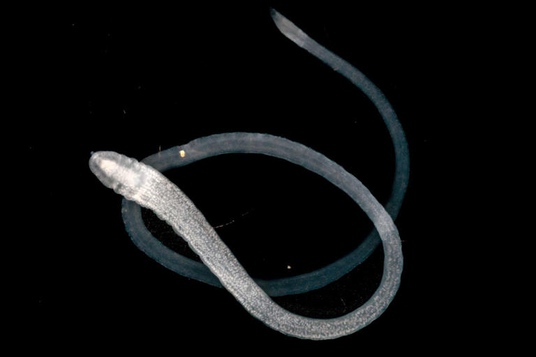 Doctors thought he had cancer. Then they found a tapeworm in his brain