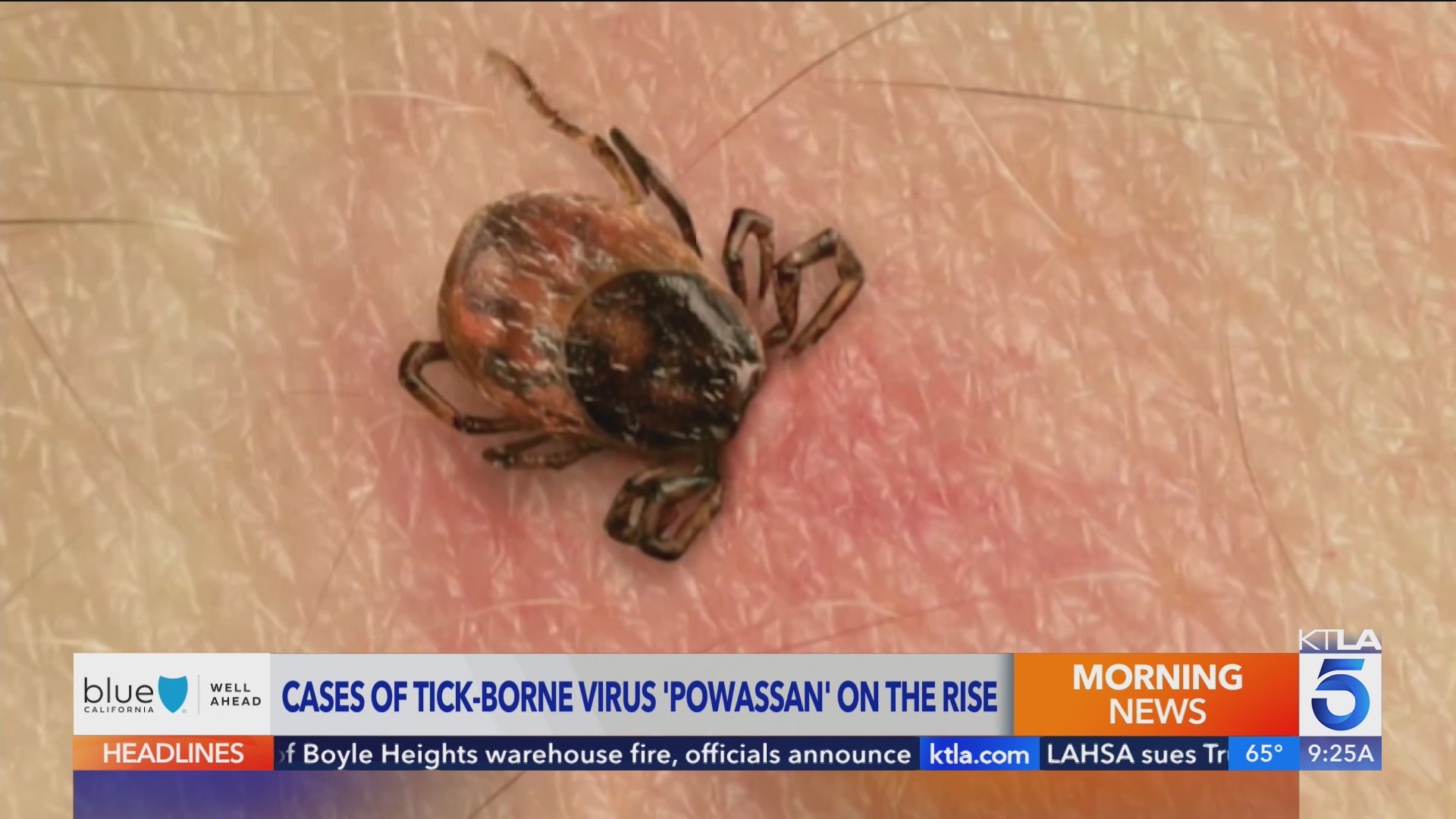 Rare but dangerous tick-borne virus on the rise in the US