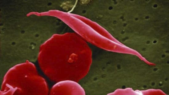 How sickle cell disease is diagnosed