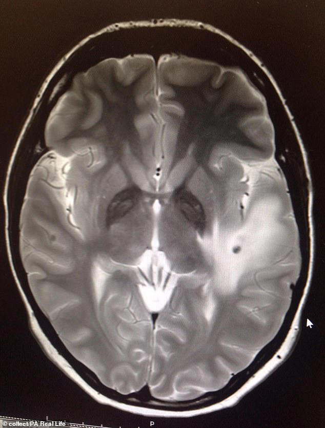 Parasite horror: I had a metre long tapeworm in my gut and 38 more in ...