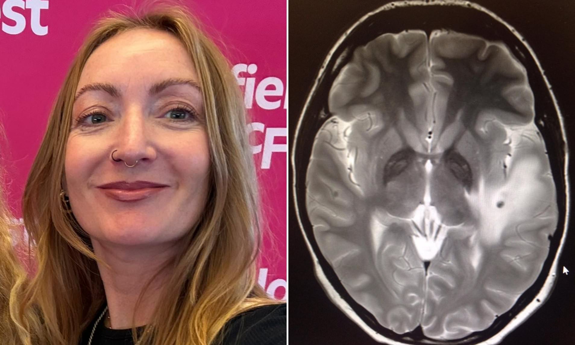 Parasite horror: I had a metre long tapeworm in my gut and 38 more in ...