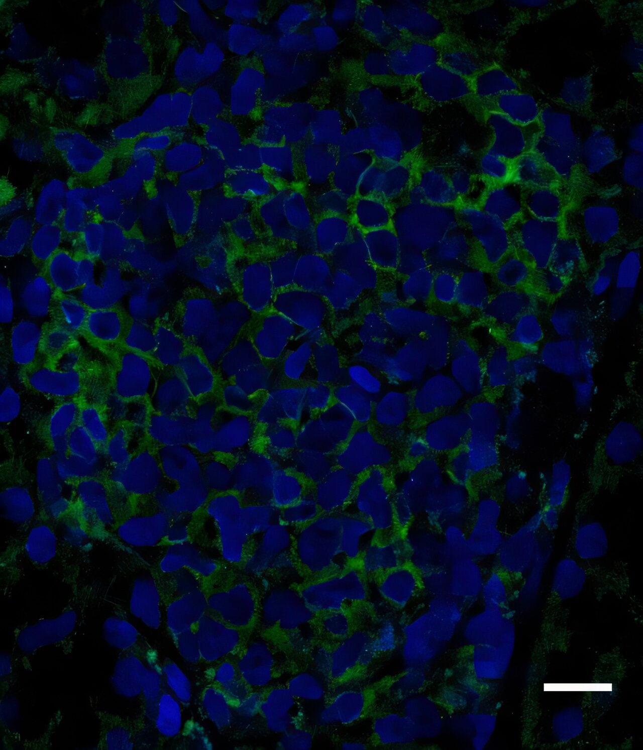 Faulty calcium signaling may drive dry mouth in Down syndrome, raising ...