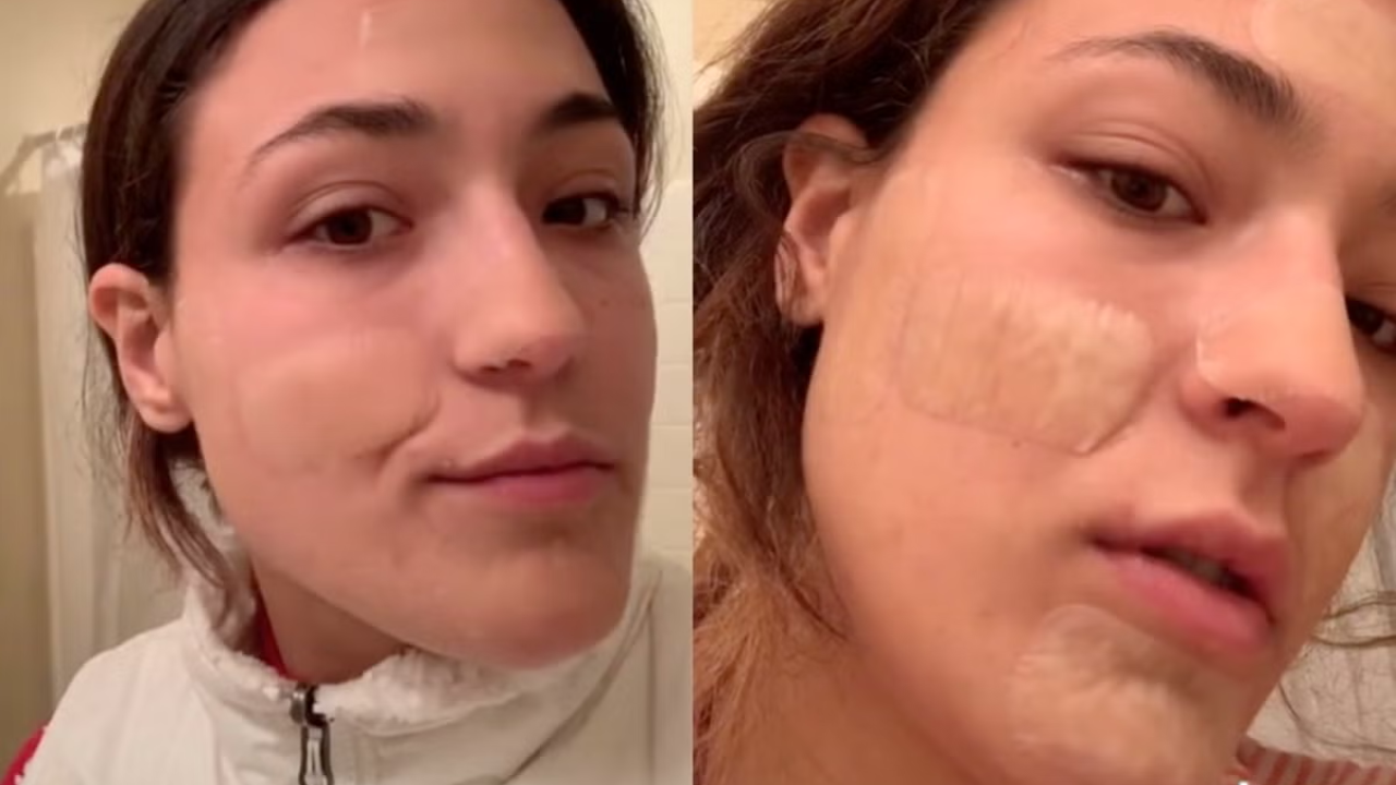Pimple patches vs hydrocolloid bandages: Which acne treatment works best?