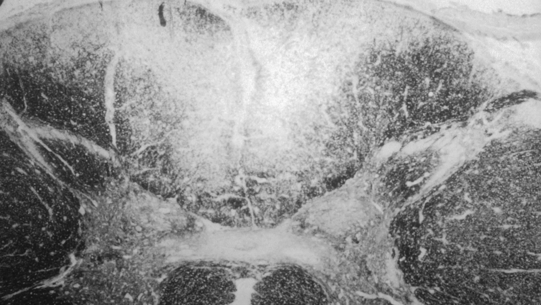 Viruses, shingles, and dementia risk