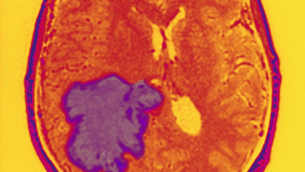 Recognizing early signs of brain tumors