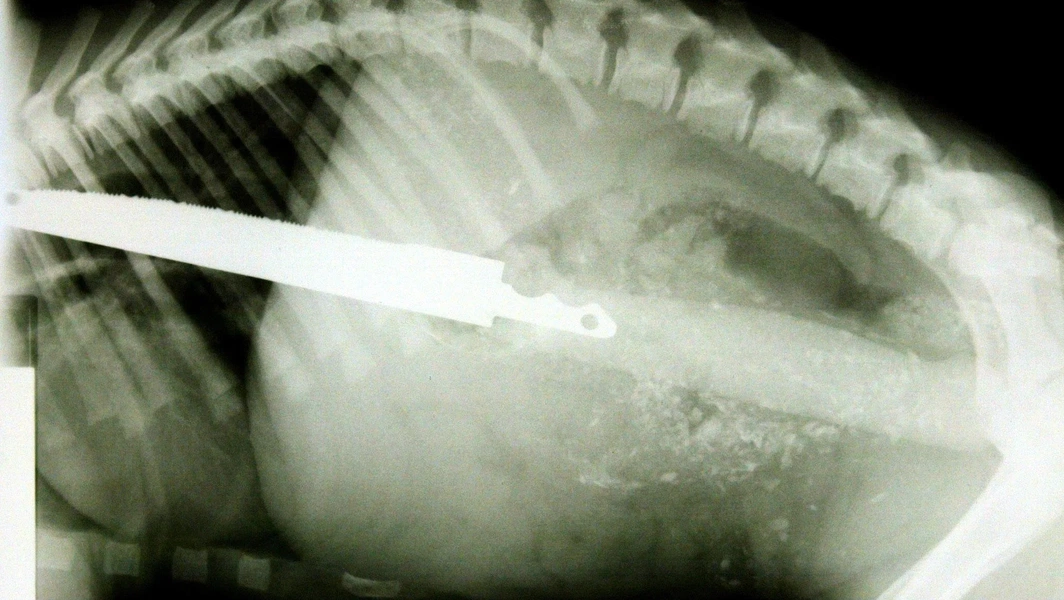 5 unusual and bizarre objects found in humans