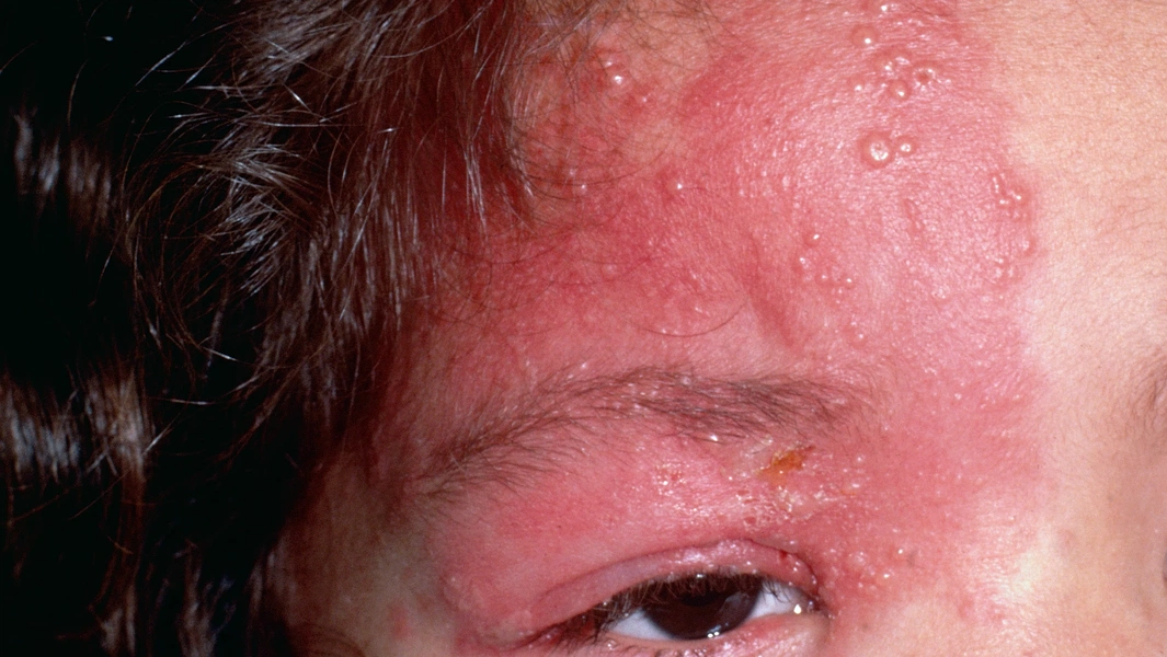 Viruses, shingles, and dementia risk