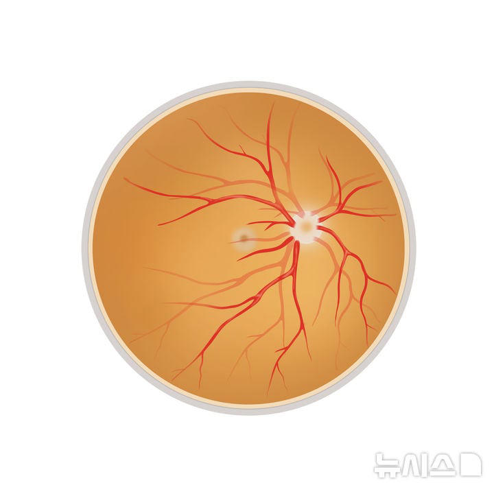 Eye drops, pills challenge injections in macular degeneration
