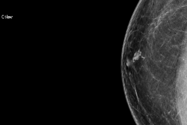 Phil had no idea men could get breast cancer. His diagnosis felt like a ...