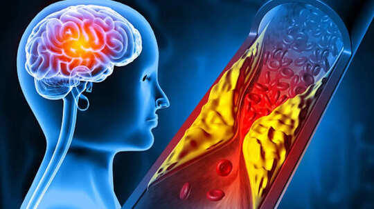 Statin muscle pain is real, says cardiologist as new study reveals the ...