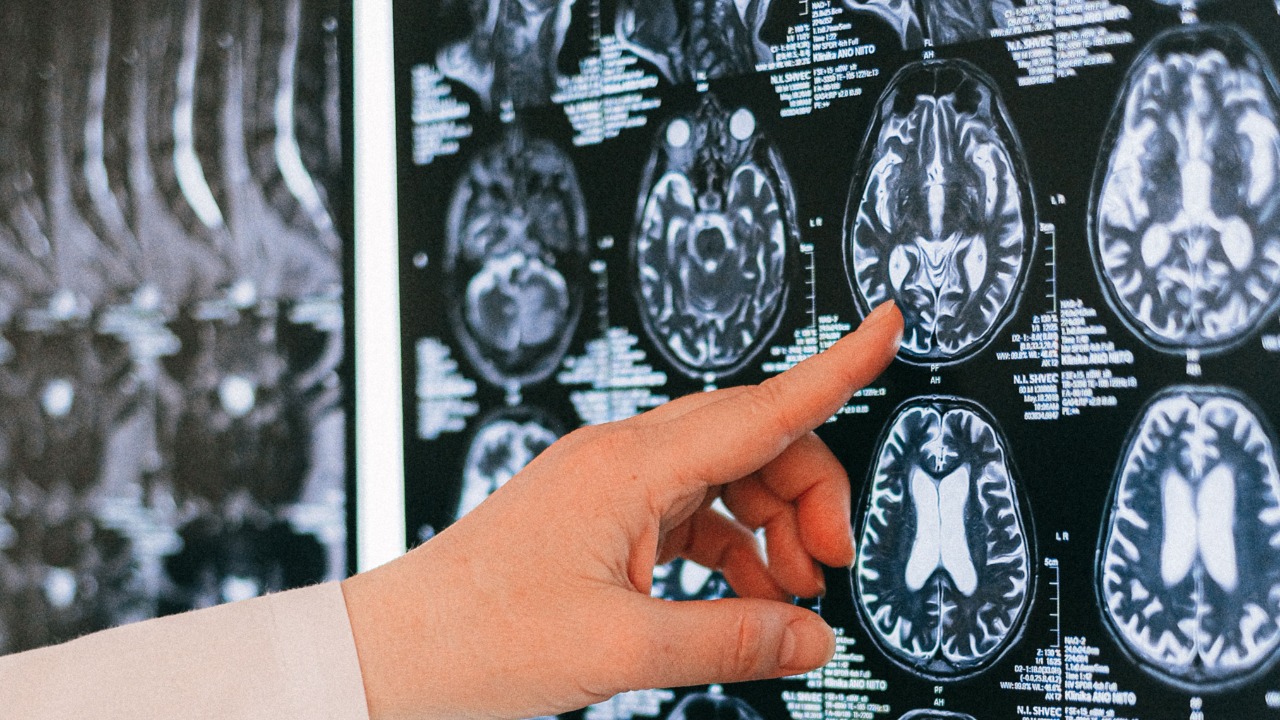 Microplastics build up in the brain at higher levels than in any other ...
