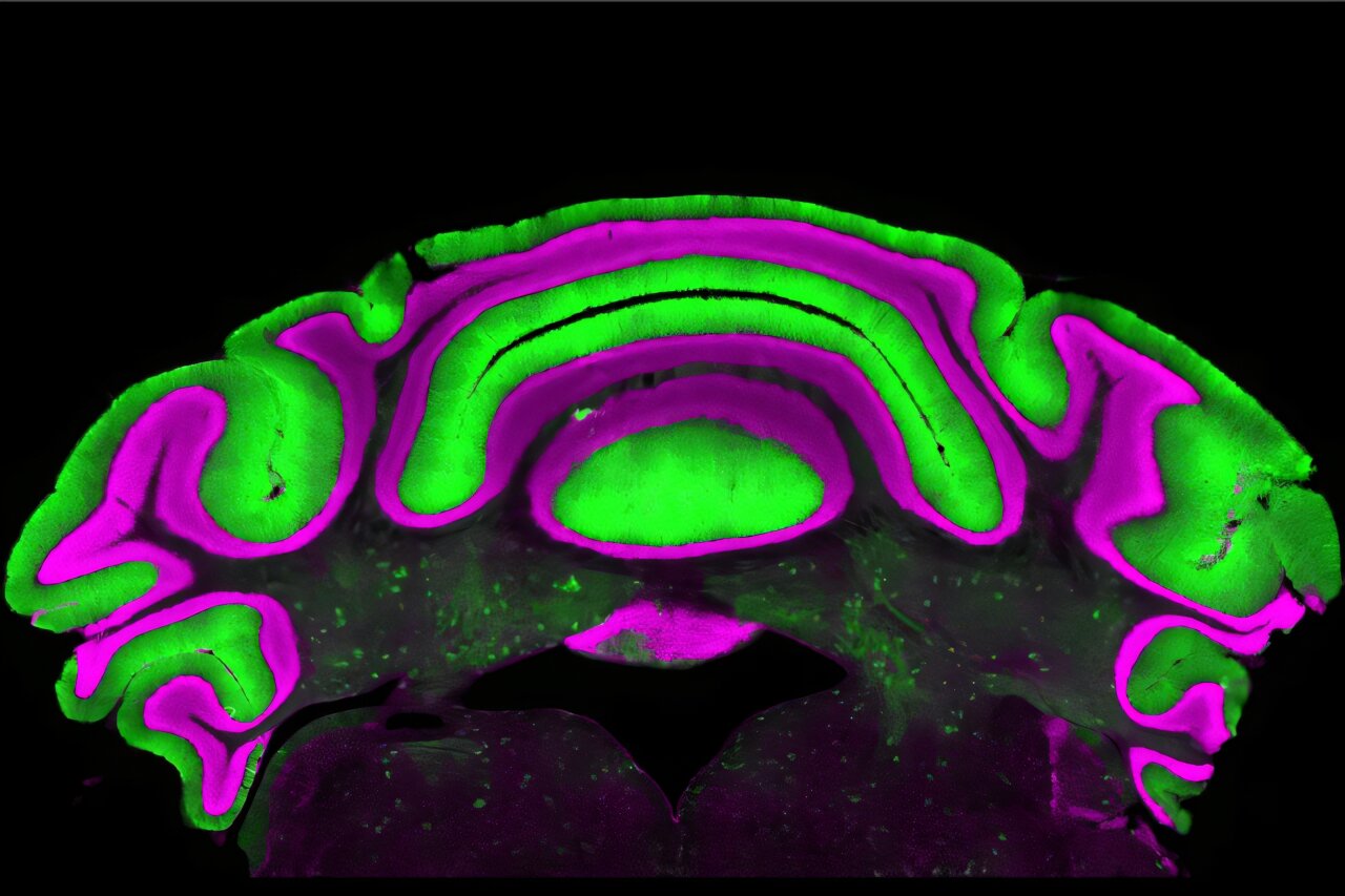 Study challenges assumption about brain activity in tremors