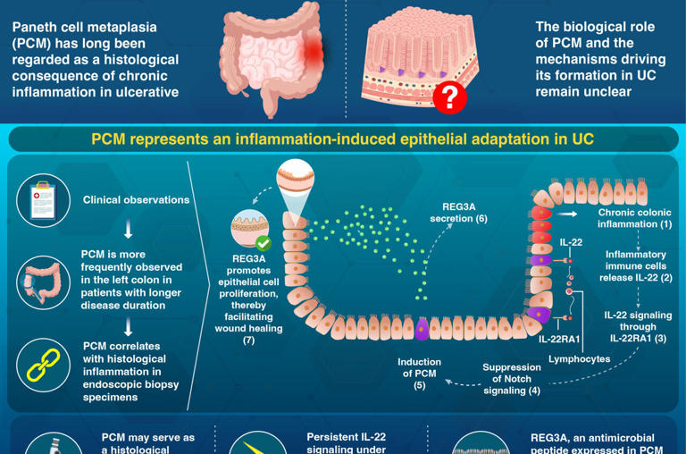 Inflammation may trigger protective cell shift in ulcerative colitis ...