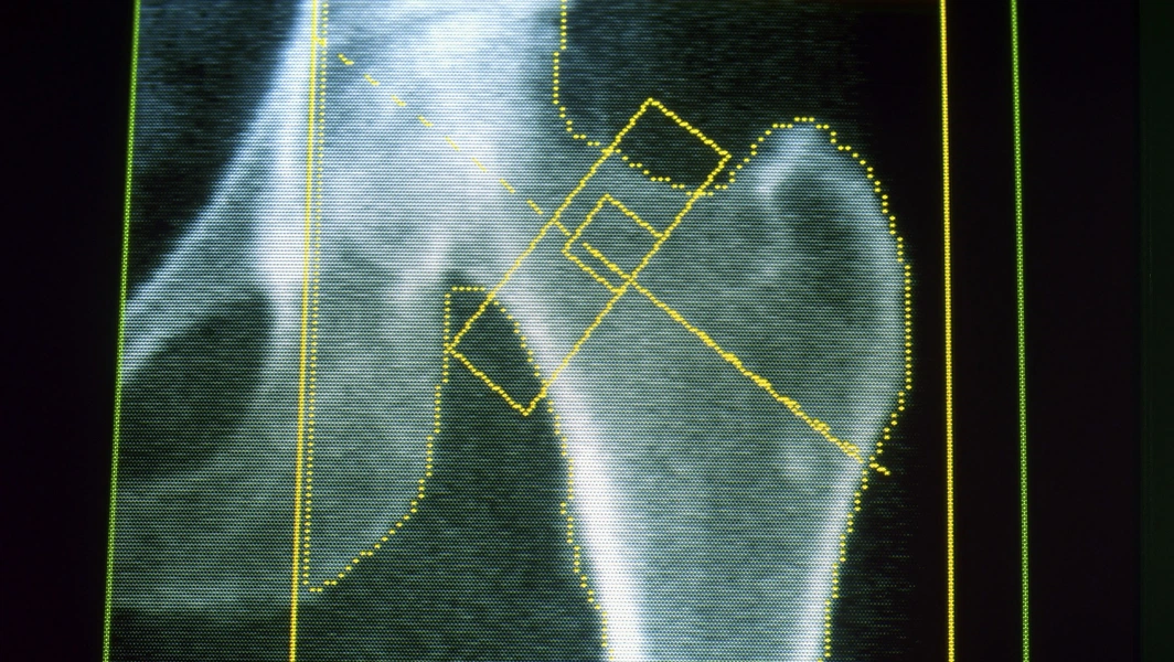 Bone health strategies for women