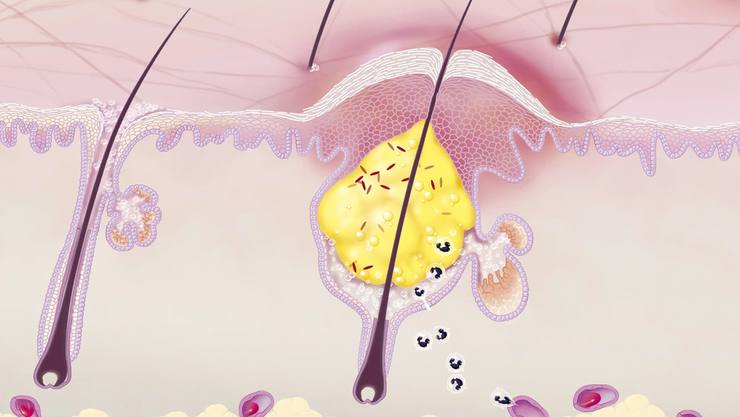 17 common and surprising acne triggers