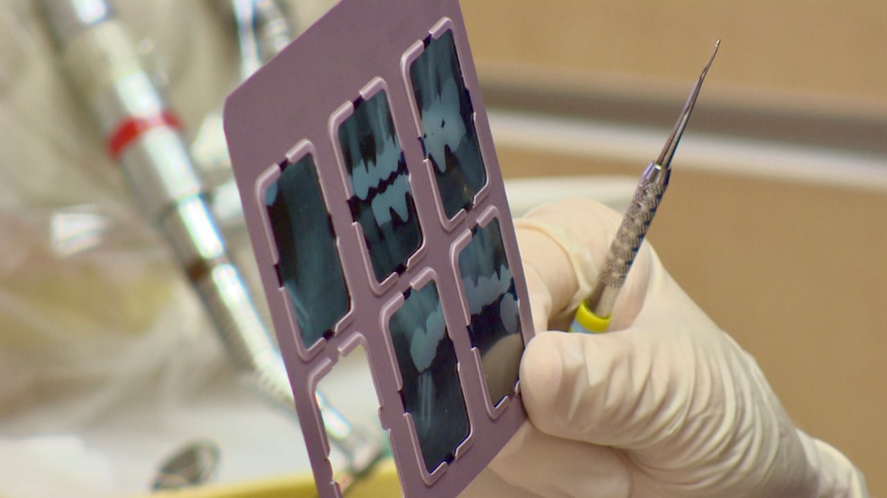 Tooth decay on the rise following fluoride removal