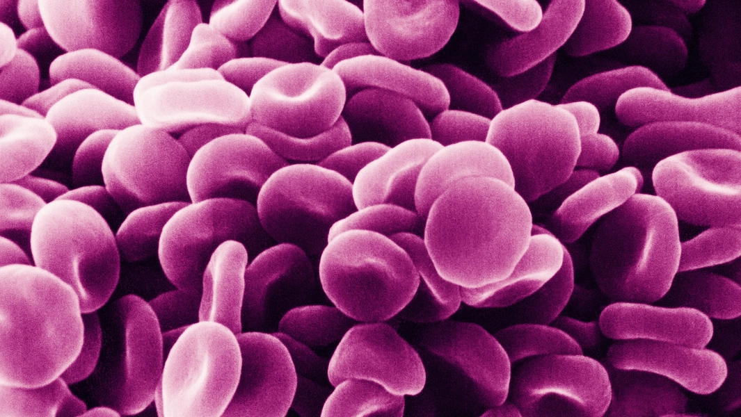 Causes, symptoms, and treatments of anemia