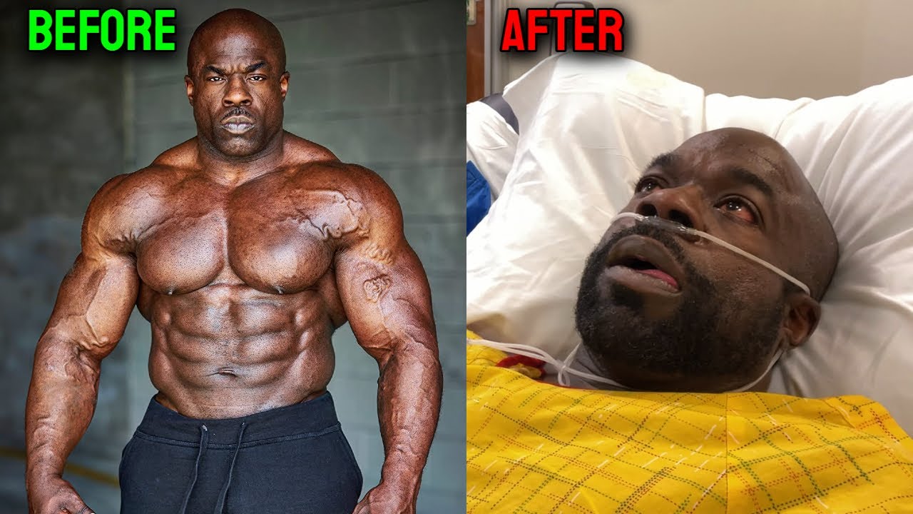 This is how steroids almost killed me