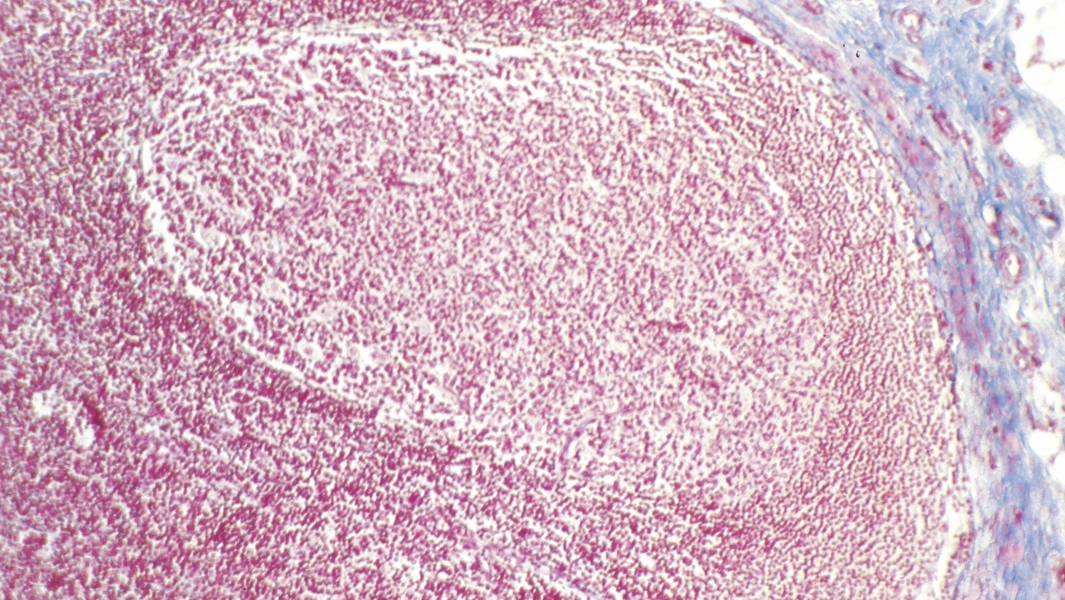 Recognizing key signs and tests for lymphoma