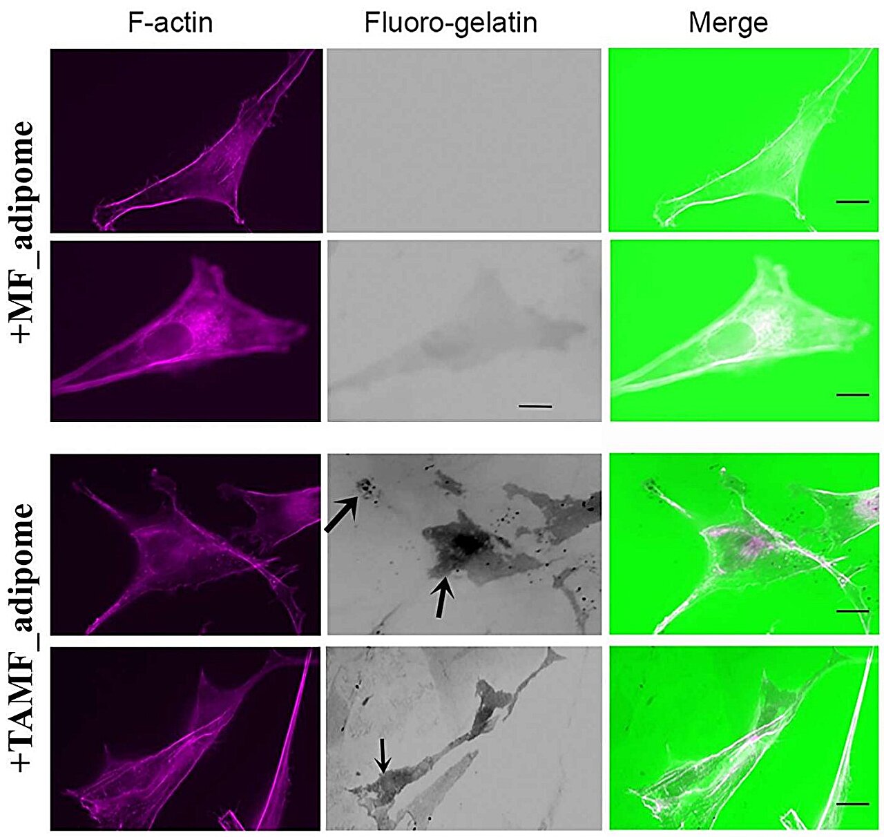Fat tissue could explain triple negative breast cancer spread—and point ...