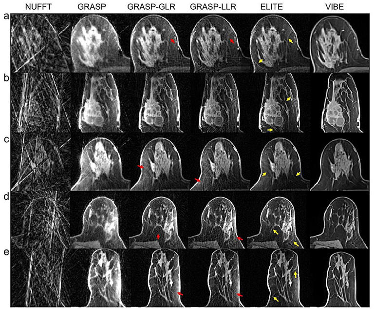 Faster breast MRI—AI unlocks one image per second and sharper tumor ...