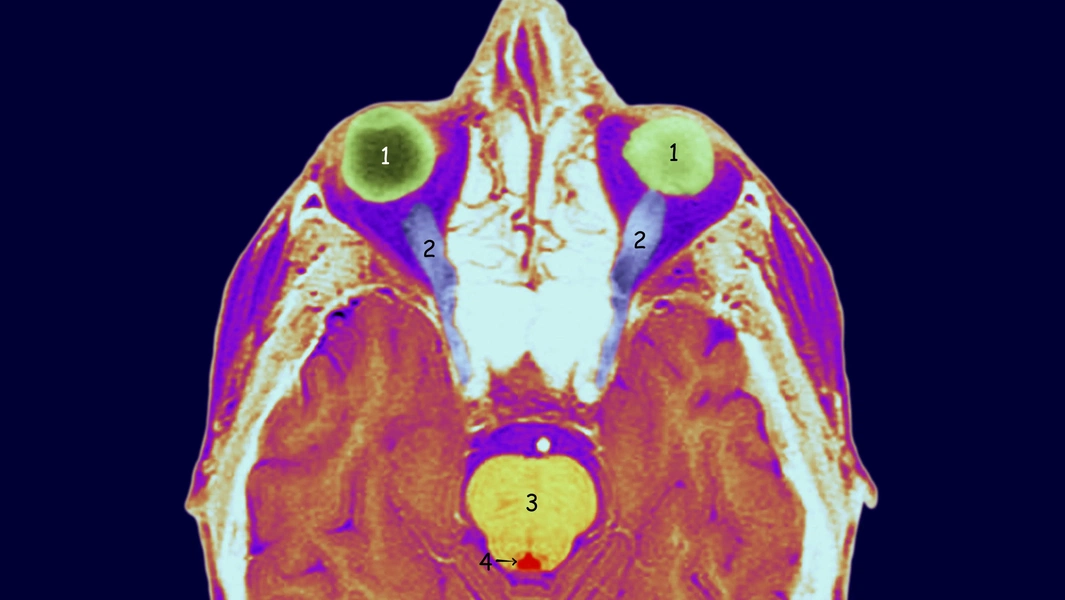 Recognizing symptoms that may indicate a brain tumor