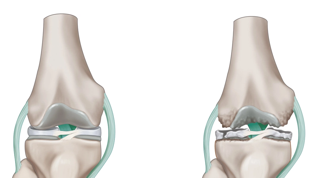 Advances in knee osteoarthritis therapies
