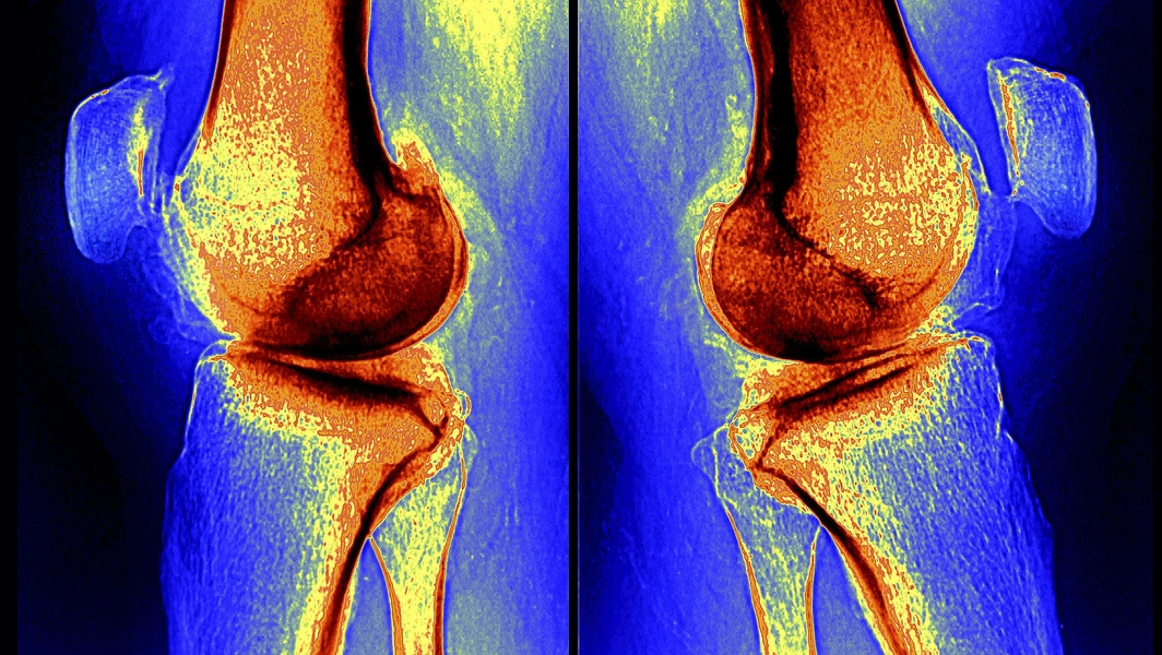 Strategies to protect and strengthen your knees