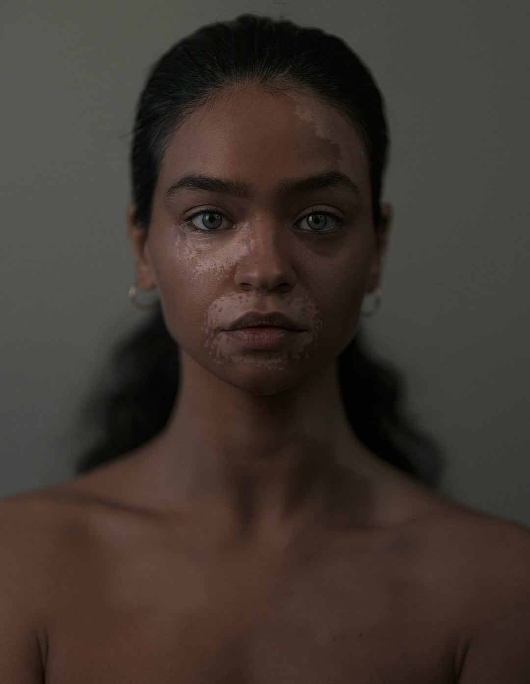 Can vitiligo spread? Dermatologist explain what really causes new white ...