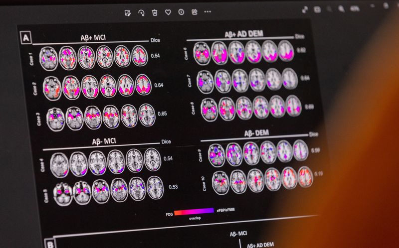 ALZpath signs licensing deal with Abbott to develop Alzheimer's blood test