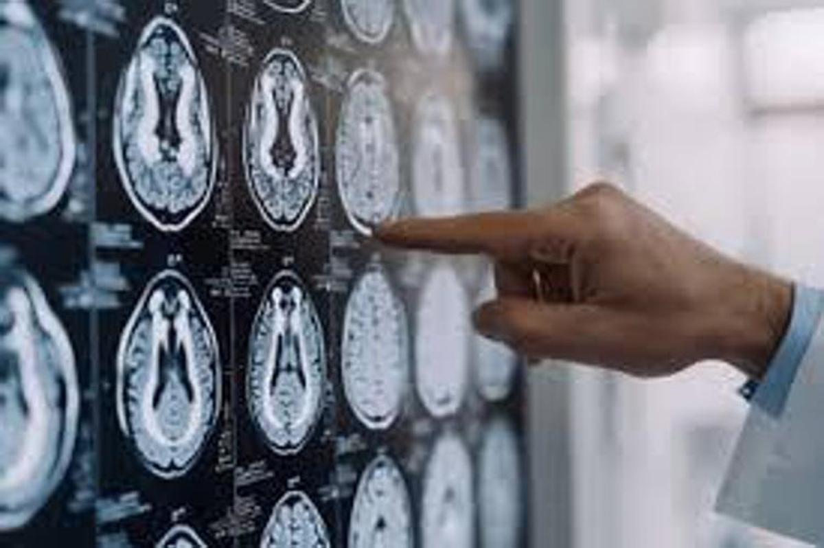 Centro DBS Pavia, 100 interventi di neurostimolazione profonda per ...
