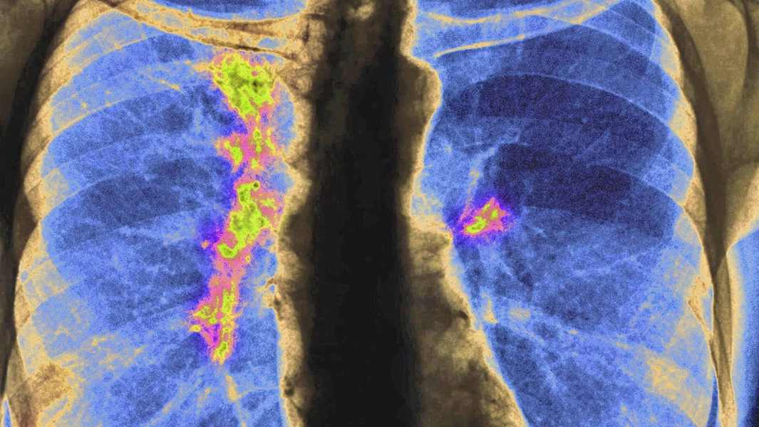 13 early signs that may indicate lung cancer