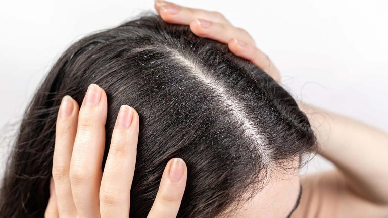 Why your dandruff keeps coming back, and what your scalp may be trying ...