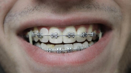 Are dental braces only for teenagers? Orthodontist debunks myths about ...