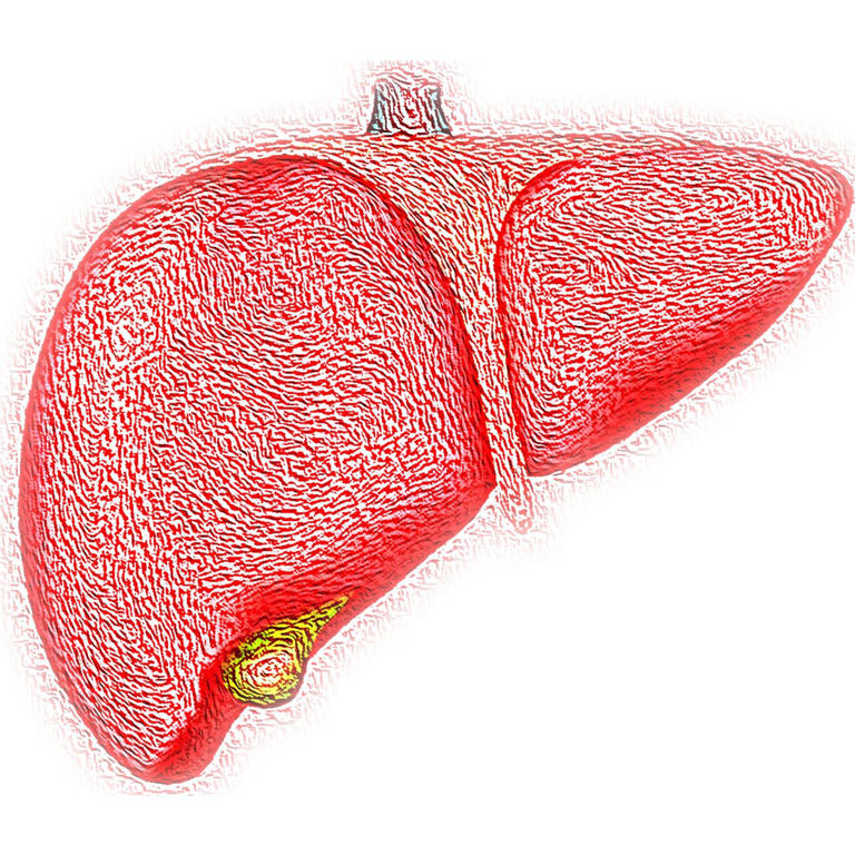 How high cholesterol dismantles the liver's defenses—and how a new drug ...