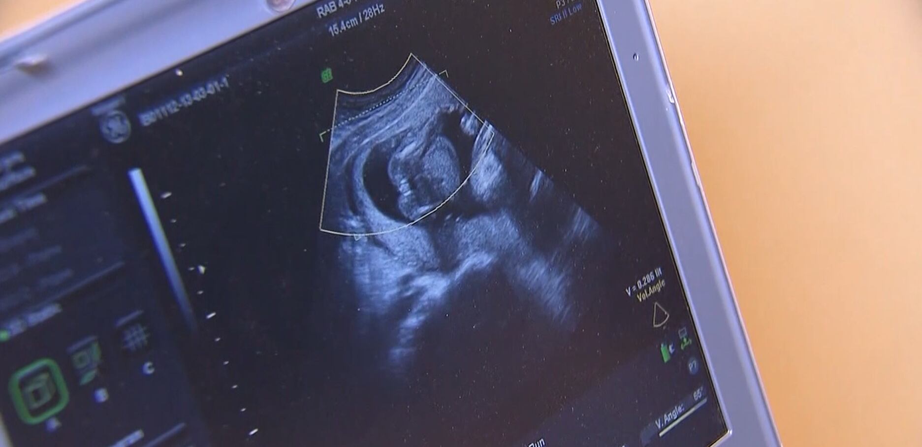 Four years after Dobbs, Alabama’s near-total abortion ban reshaped ...