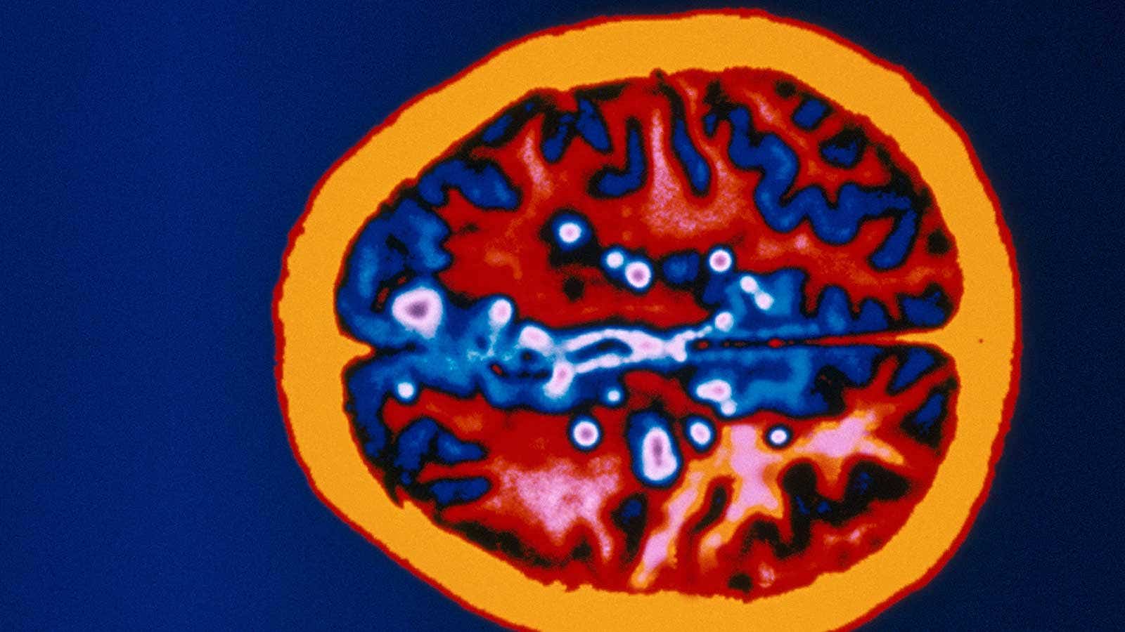 Off-label drug proves its mettle in relapsing multiple sclerosis