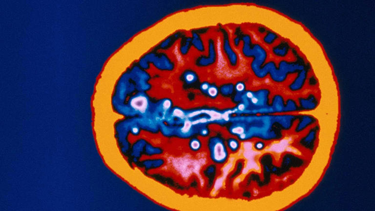 Off-label drug proves its mettle in relapsing multiple sclerosis