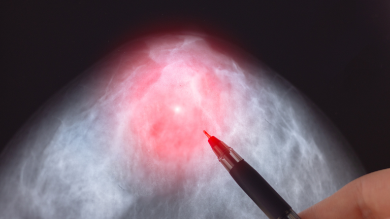 Research says AI may detect breast cancer warning signs six years ...