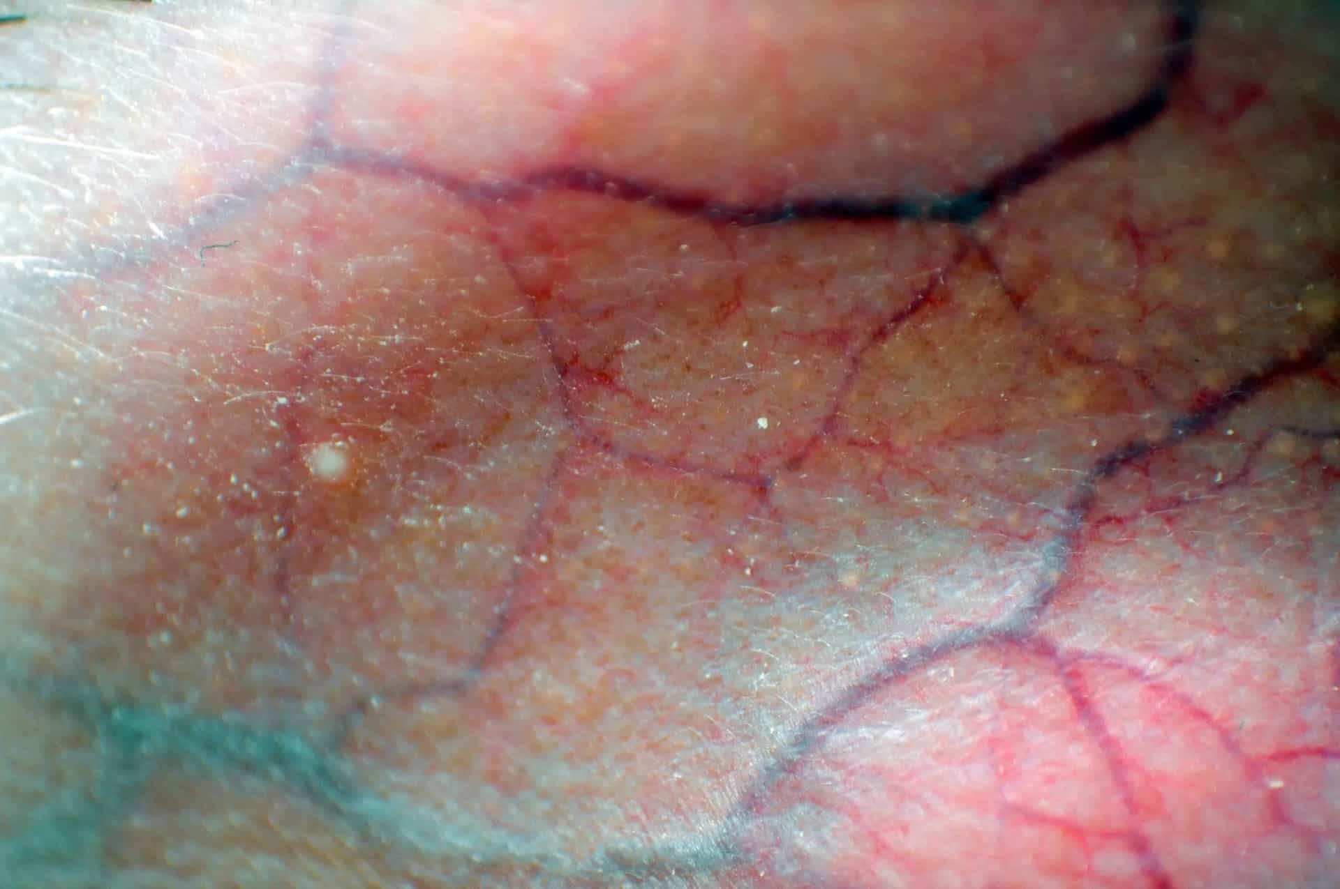 Understanding Ehlers-Danlos syndromes